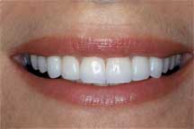 Porcelain Veneers in Boston, Newton and Wellesley, MA | Newton Dental ...
